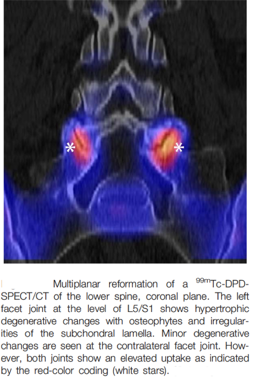 Facet Joint injections for back pain | Dr LEON CREANEY