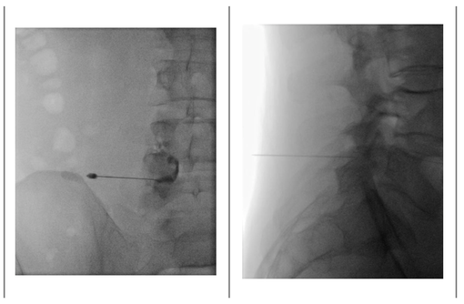 Facet Joint injections for back pain | Dr LEON CREANEY
